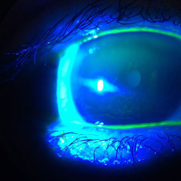 Bilateral Exposure Keratopathy - Ophthalogix
